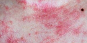 Nhs Skin Conditions Pictures: Your Essential Visual Guide