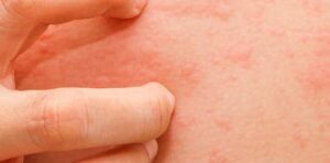 Zinc Deficiency Skin Conditions: Causes And Solutions